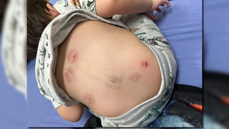 'How can you not notice eight bites?' Family alleges toddler's injuries ...