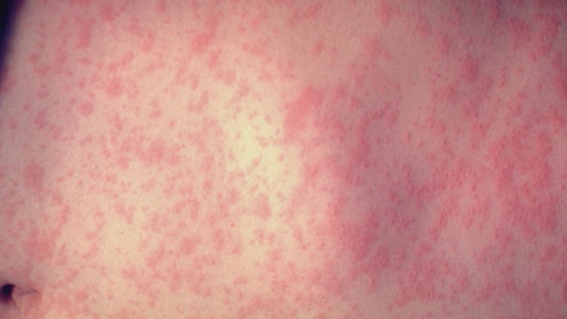 Signs of measles, plus can you get it twice? | Your questions answered ...