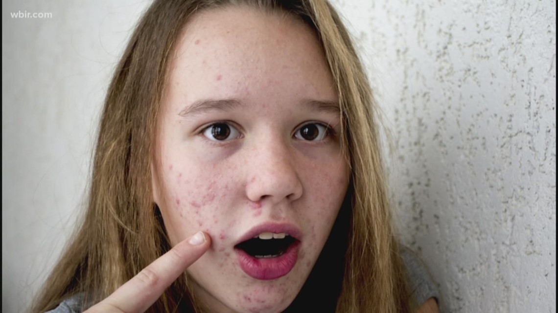 Teenage acne linked to success later in life | wbir.com