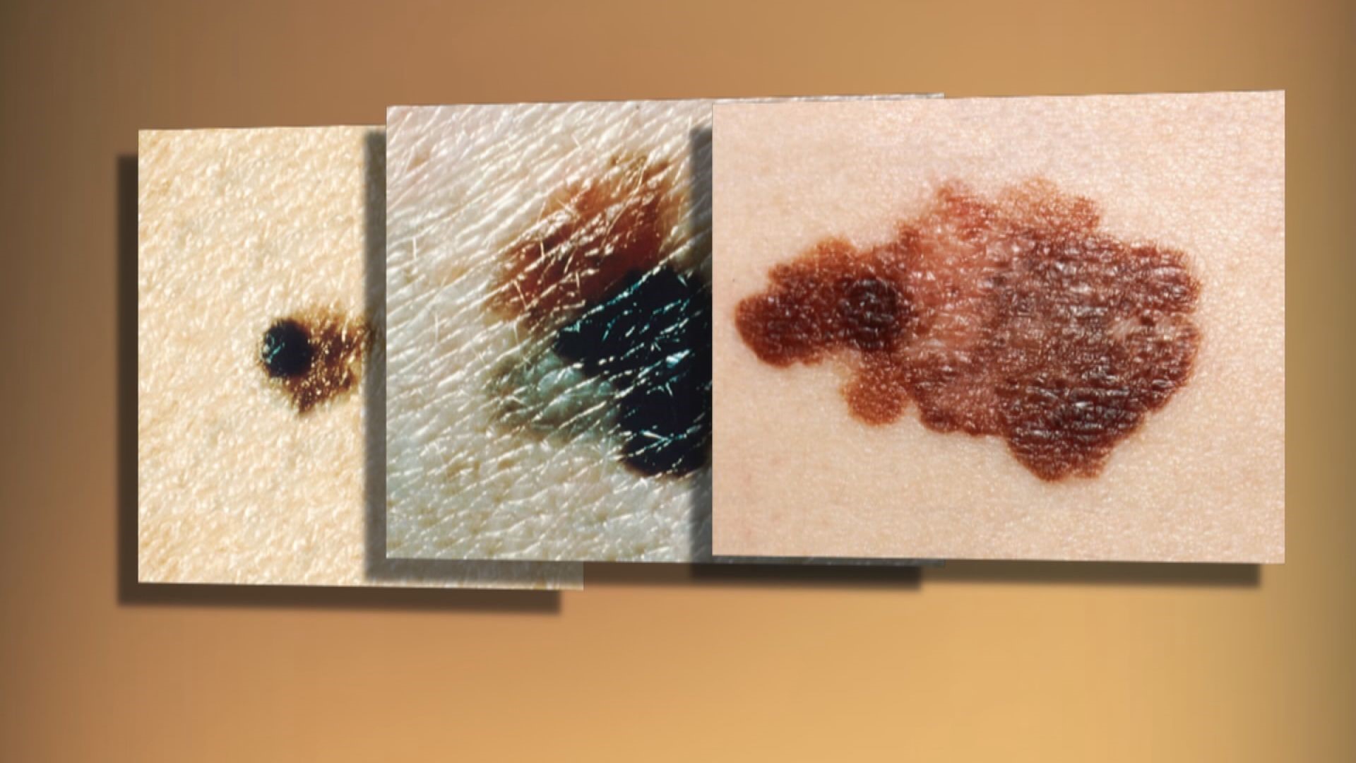 Dermatologists show how to spot and identify 3 types of skin cancer ...