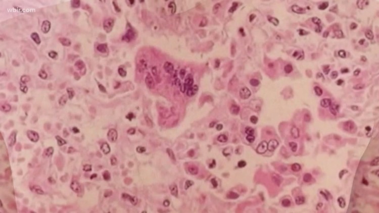 Here's what everyone needs to understand about the measles virus | wbir.com