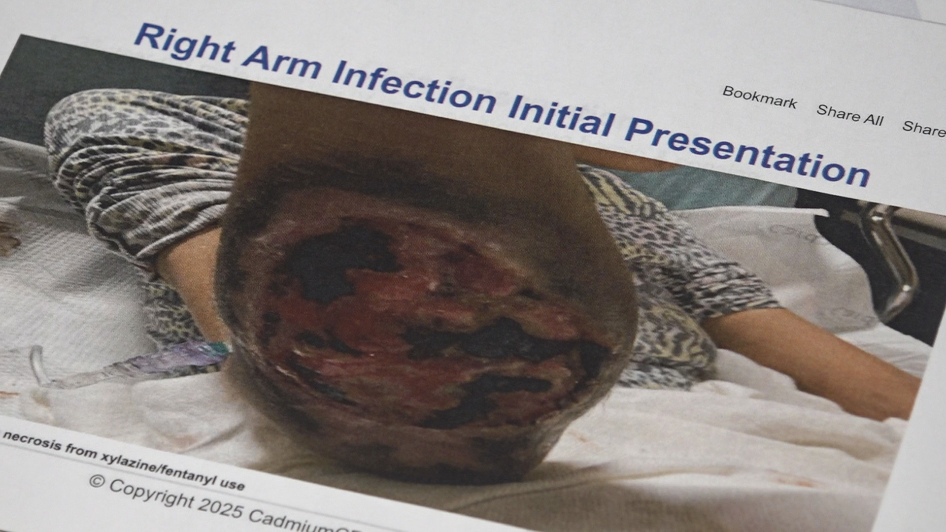 Toxic Trends: Tracking Tranq | Former user shares her story, aftermath ...