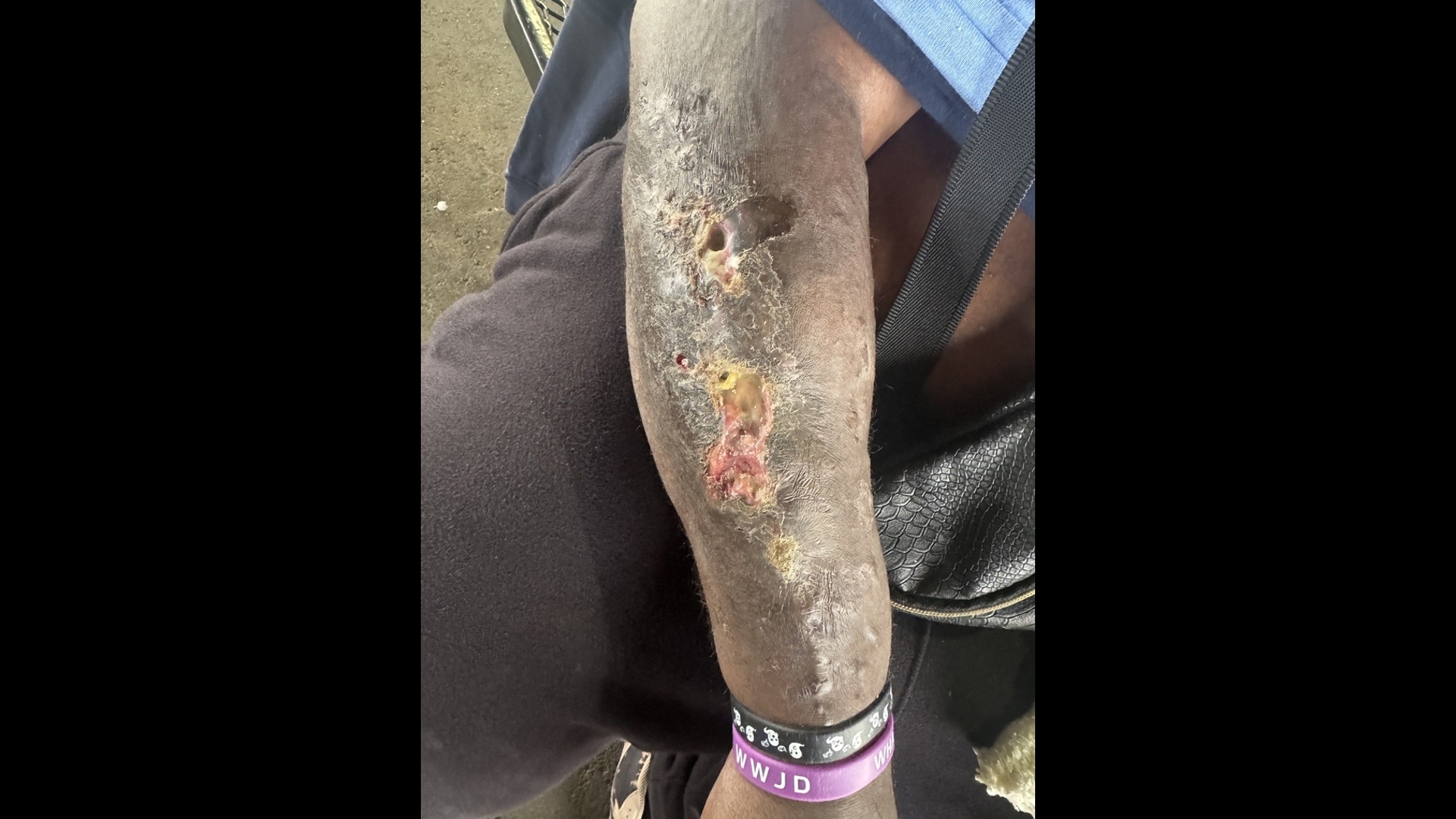 Advocates give out testing strips to test for Xylazine's presence ...