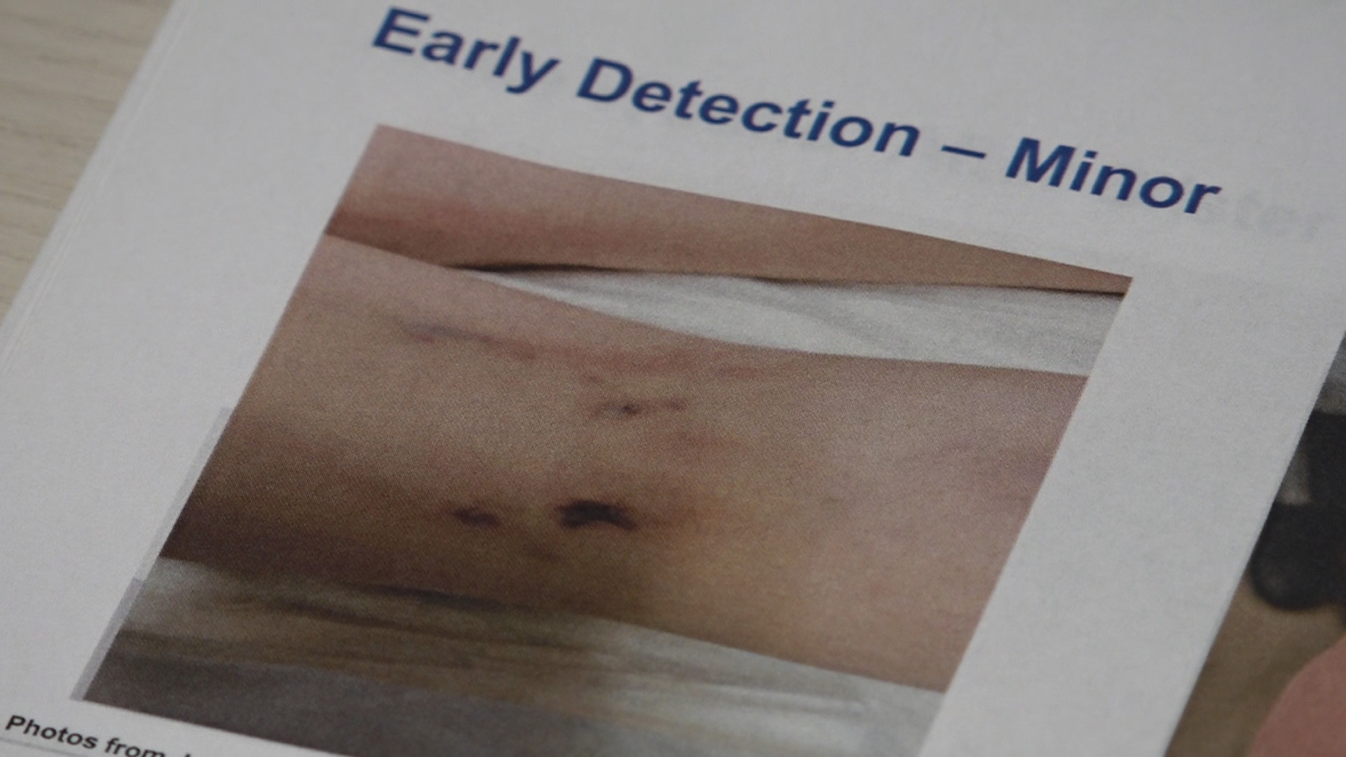 Toxic Trends: Tracking Tranq | Former user shares her story, aftermath ...