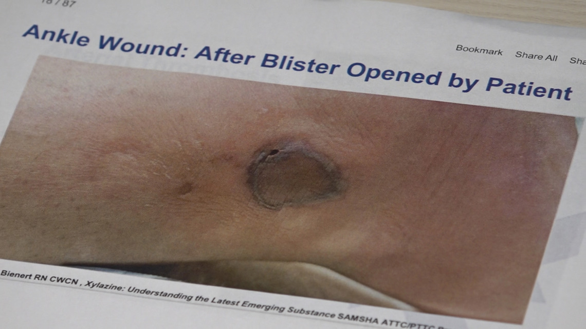 Toxic Trends: Tracking Tranq | Former user shares her story, aftermath ...