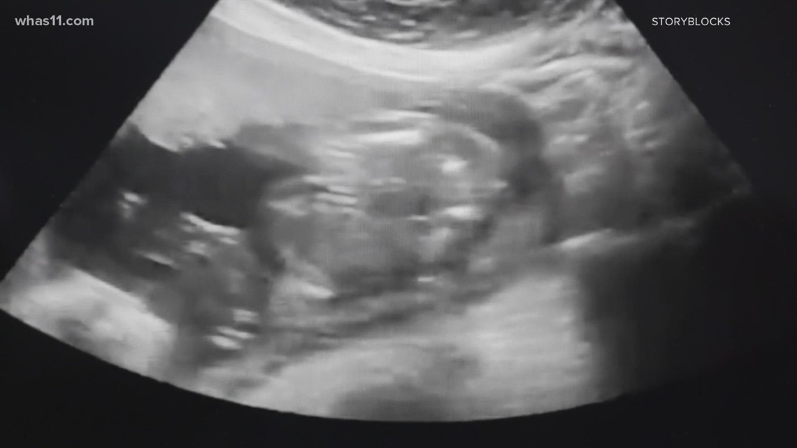 Fertility fraud now illegal in Kentucky | wbir.com