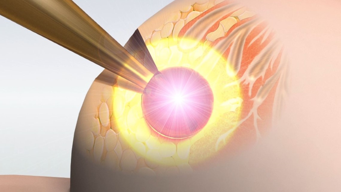 Faster treatment for early stage breast cancer with IORT | wbir.com